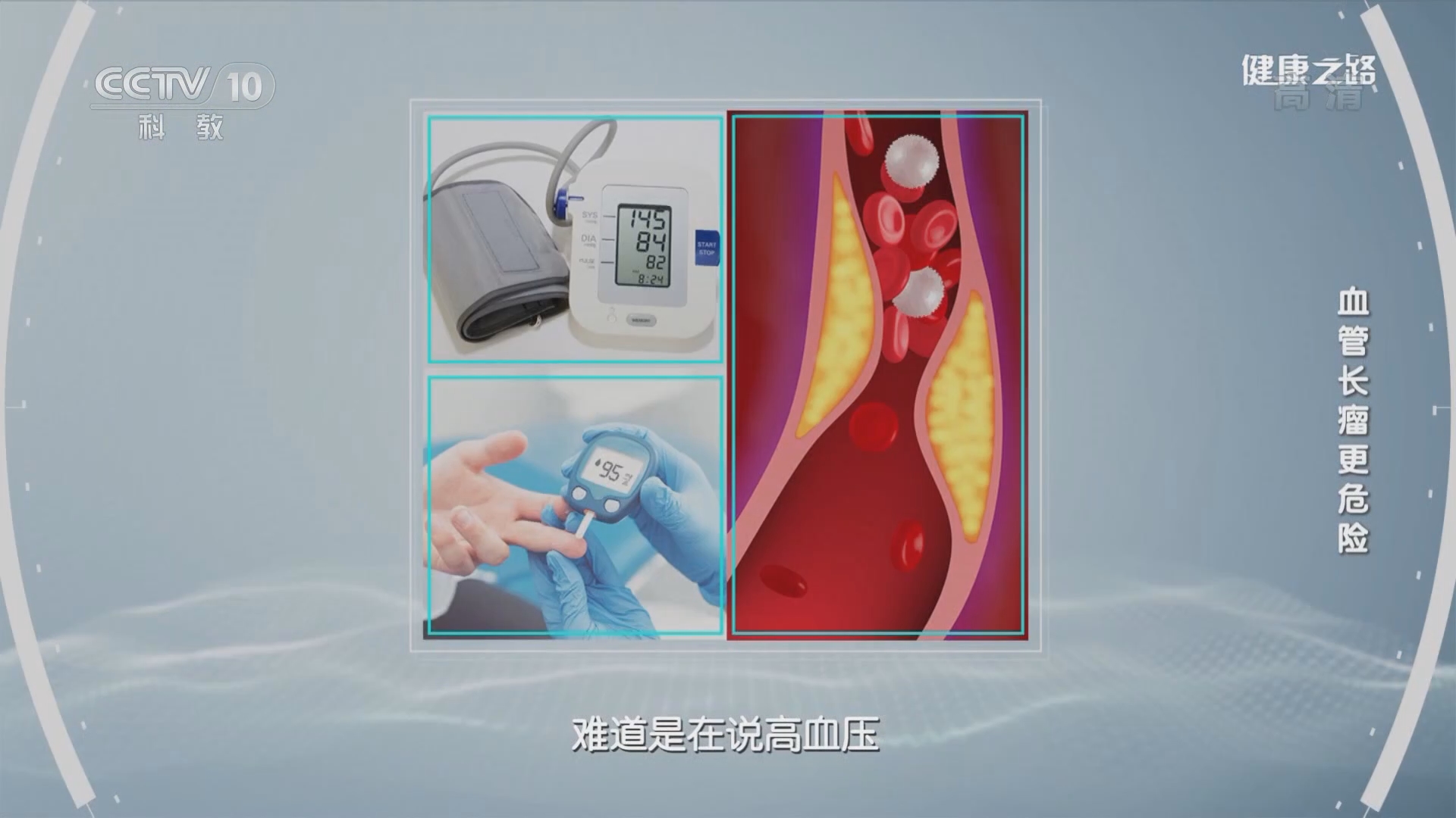 [健康之路]血管长瘤更危险 主动脉瘤高危因素:“三高”