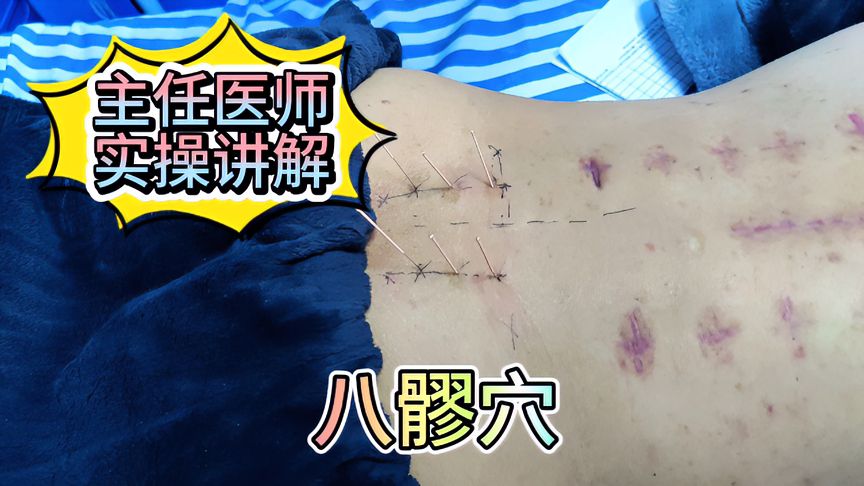 病案精讲:八髎穴如何定位取穴?主任医师,针灸实操讲解!