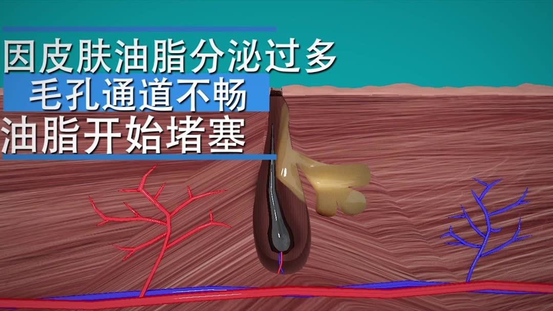 3D动画痘痘一直去不掉,你知道为什么吗?