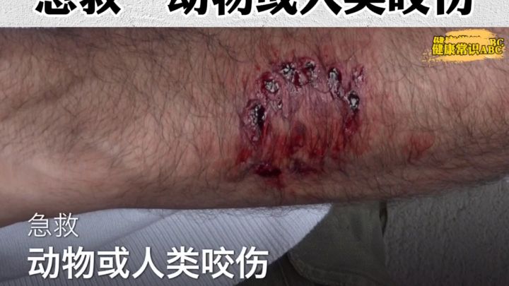 学习急救—动物或人类咬伤