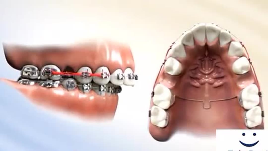 拔牙矫正的过程是怎样的