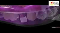 种植牙取模登腾