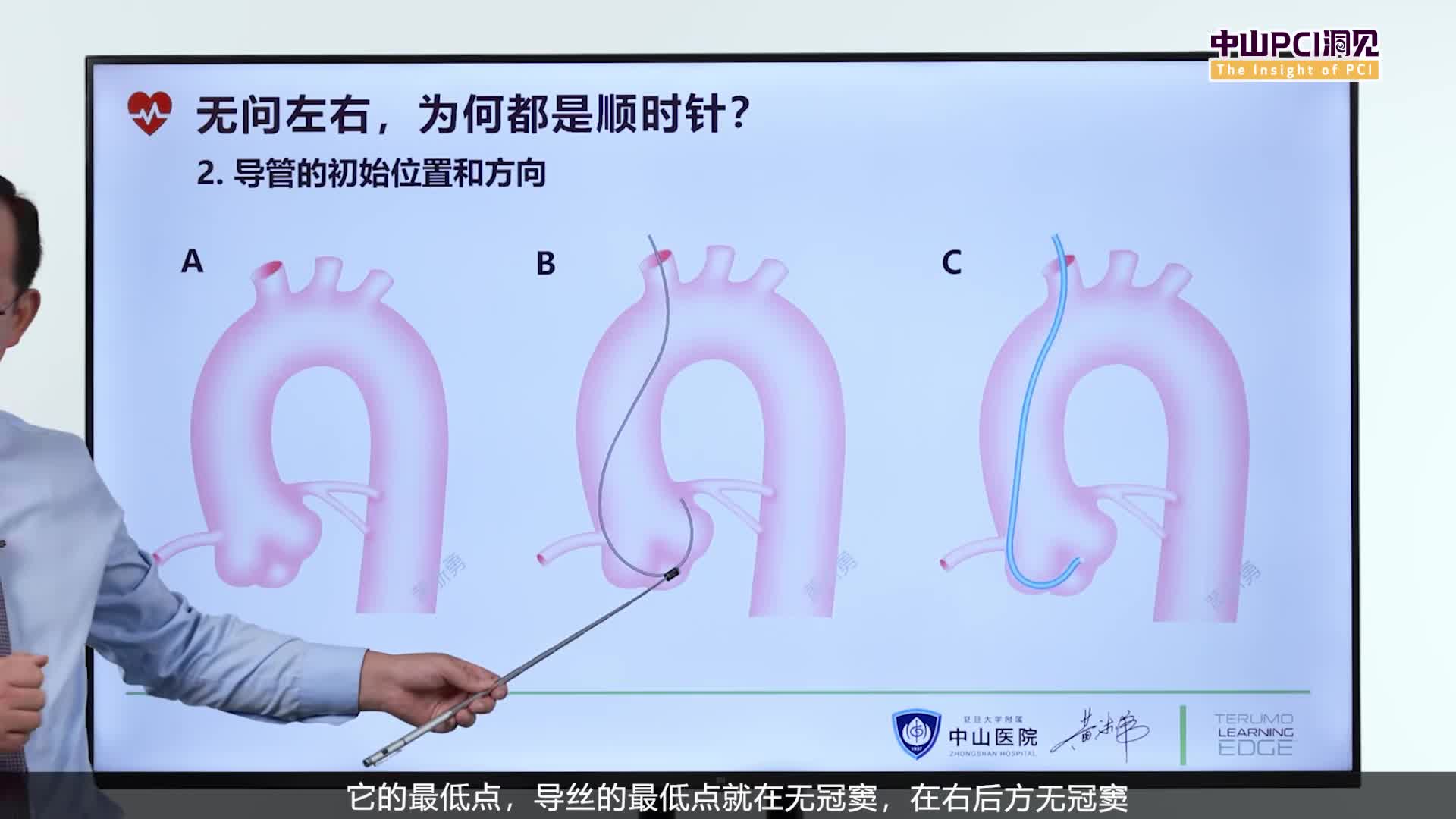 中山PCI洞见|71. 指引导管无问左右,为何都是顺时针旋转到位?
