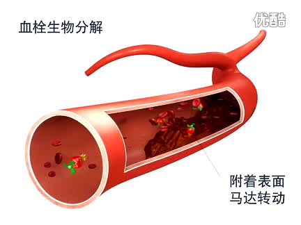 纳米机器人血管清淤动画