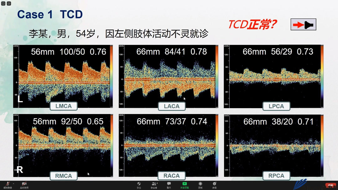 第十二期-张洁:头颈部血管超声常用试验的方法、意义和注意事项