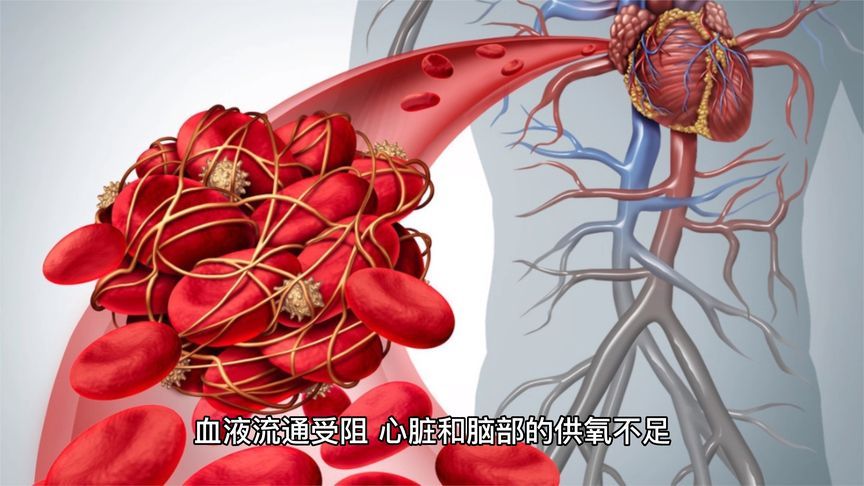 听人说动脉粥样硬化能逆转、斑块也能消除是真的吗?如何做才可以