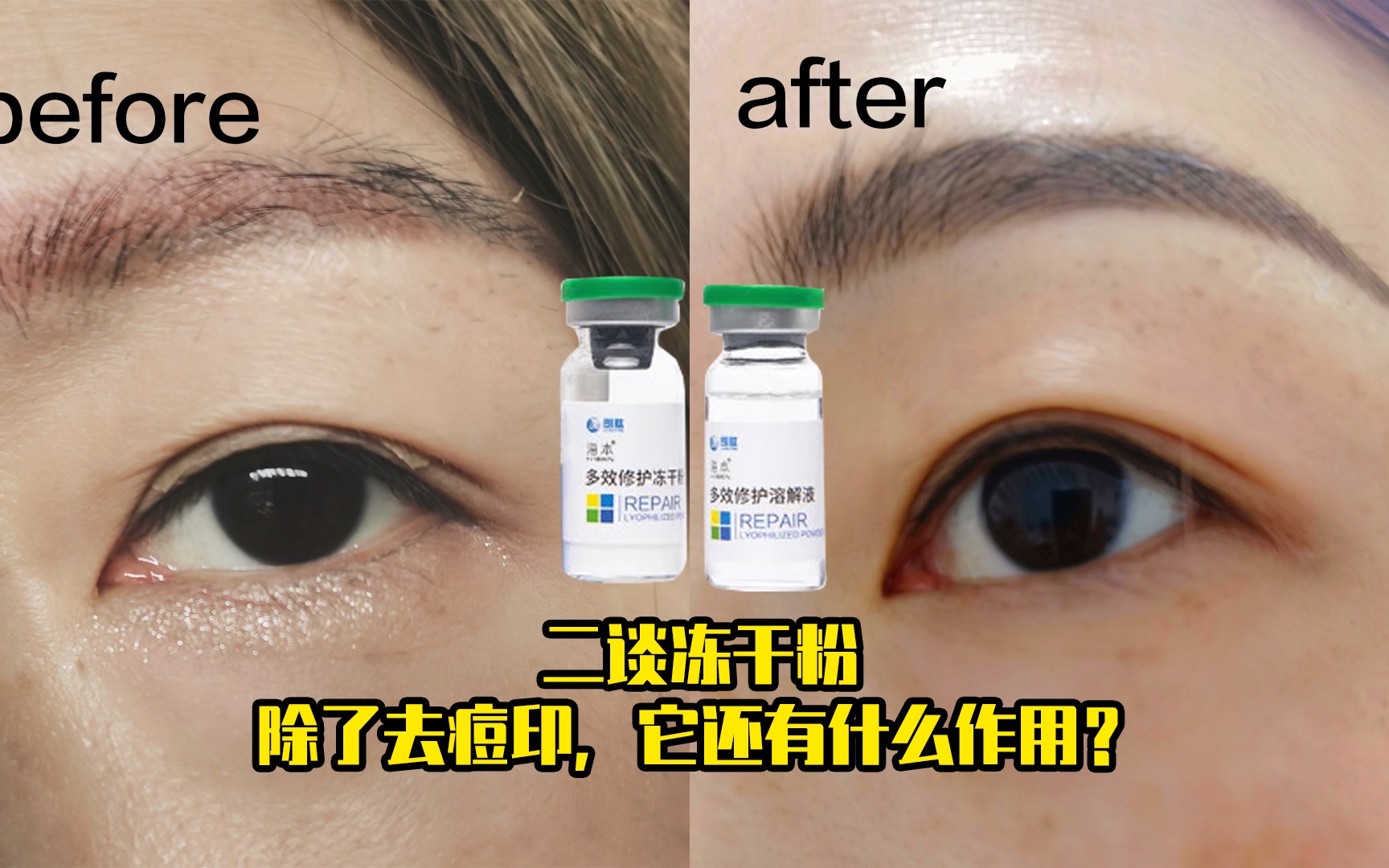 二谈冻干粉—除了去痘印,它还有什么作用?