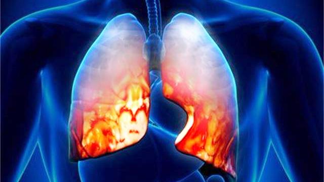 如何快速区分细菌性肺炎和病毒性肺炎?医生指出这2点本质区别!