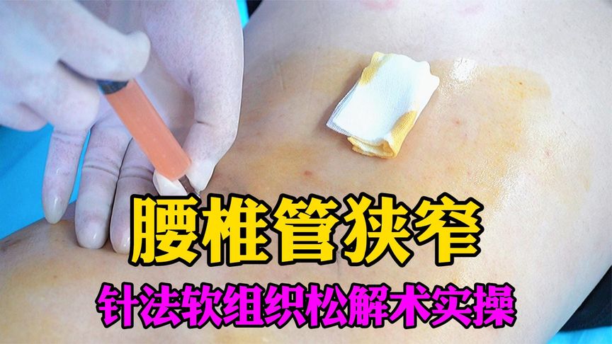 射频消融术后20天复发腰椎管狭窄,所幸教授针法帮我修复神经