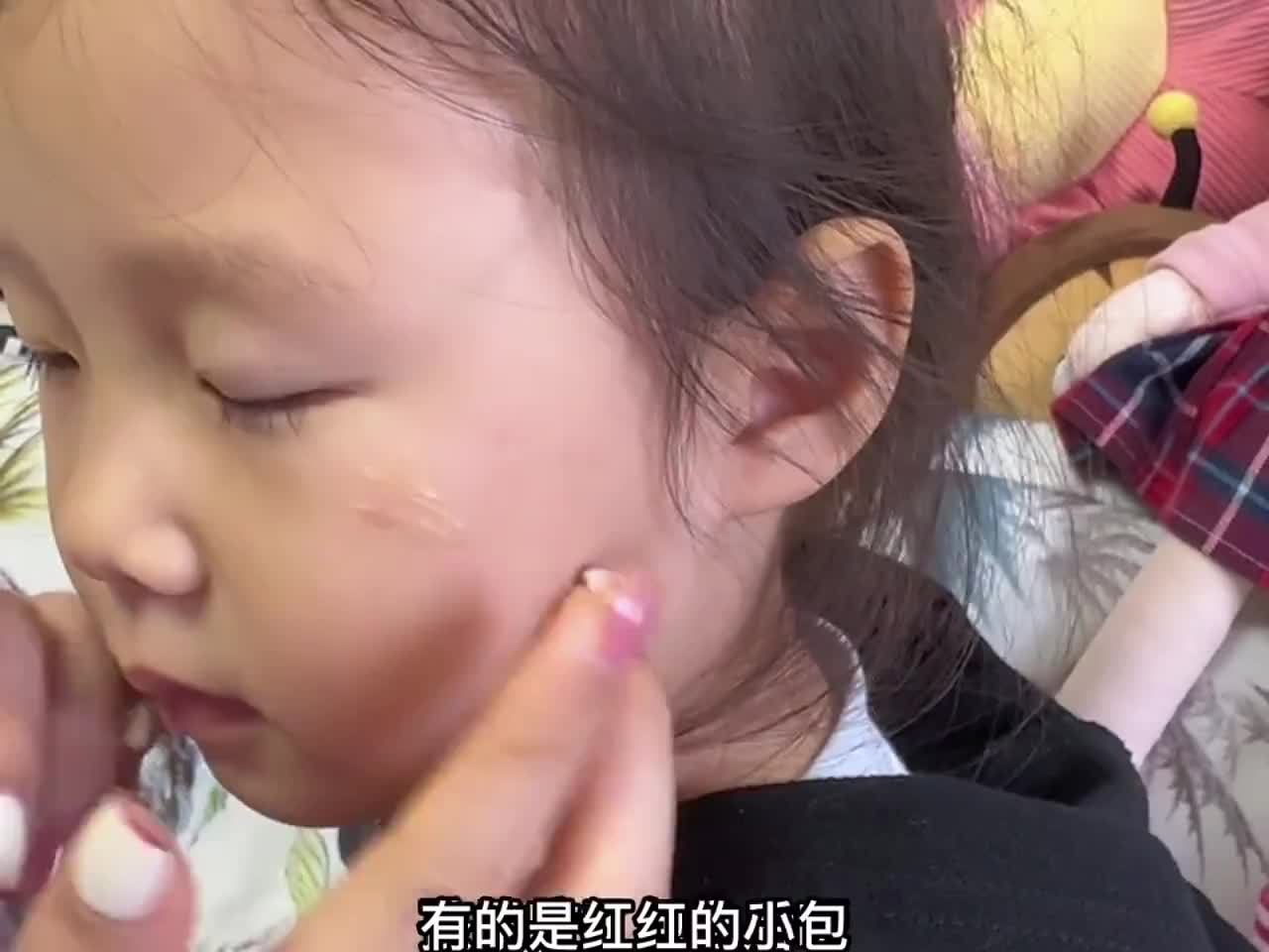 天热了 小虫蚊子专挑宝宝咬 宝弘的舒缓膏 植物的小孩大人放心用