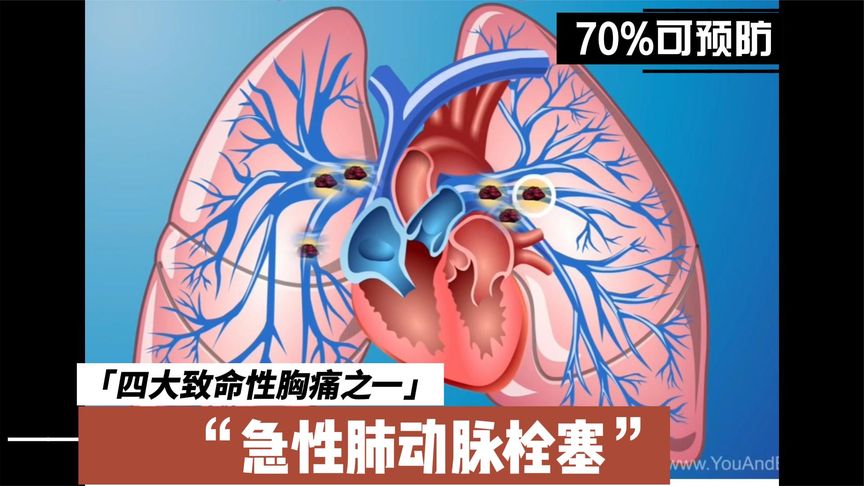 有些猝死是可以预防的 | 四大致命性胸痛之一:急性肺动脉栓塞