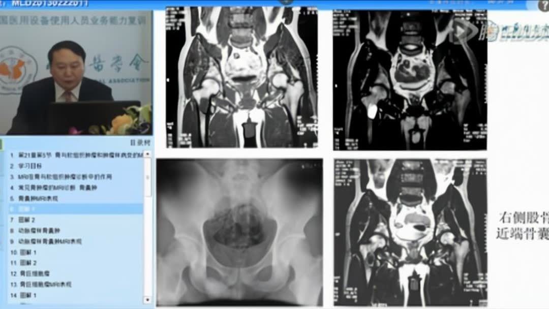 【MRI医师上岗证】骨与软组织肿瘤和肿瘤样病变的MRI诊断