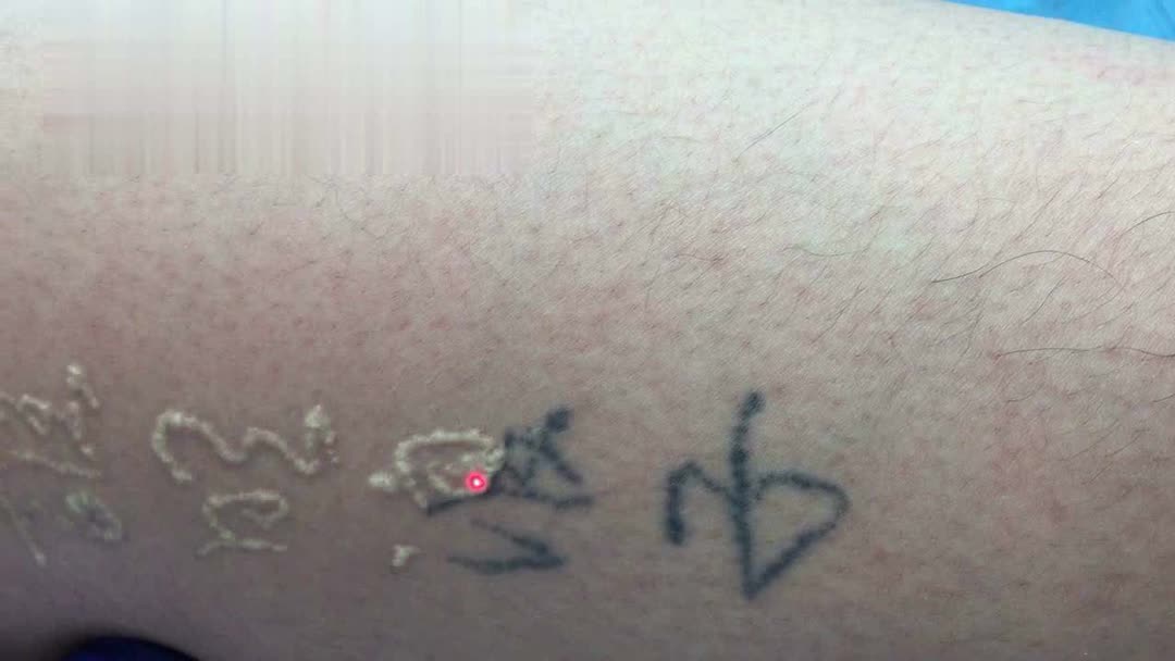 广州洗纹身给美女皮秒洗纹身洗小腿黑图腾记录