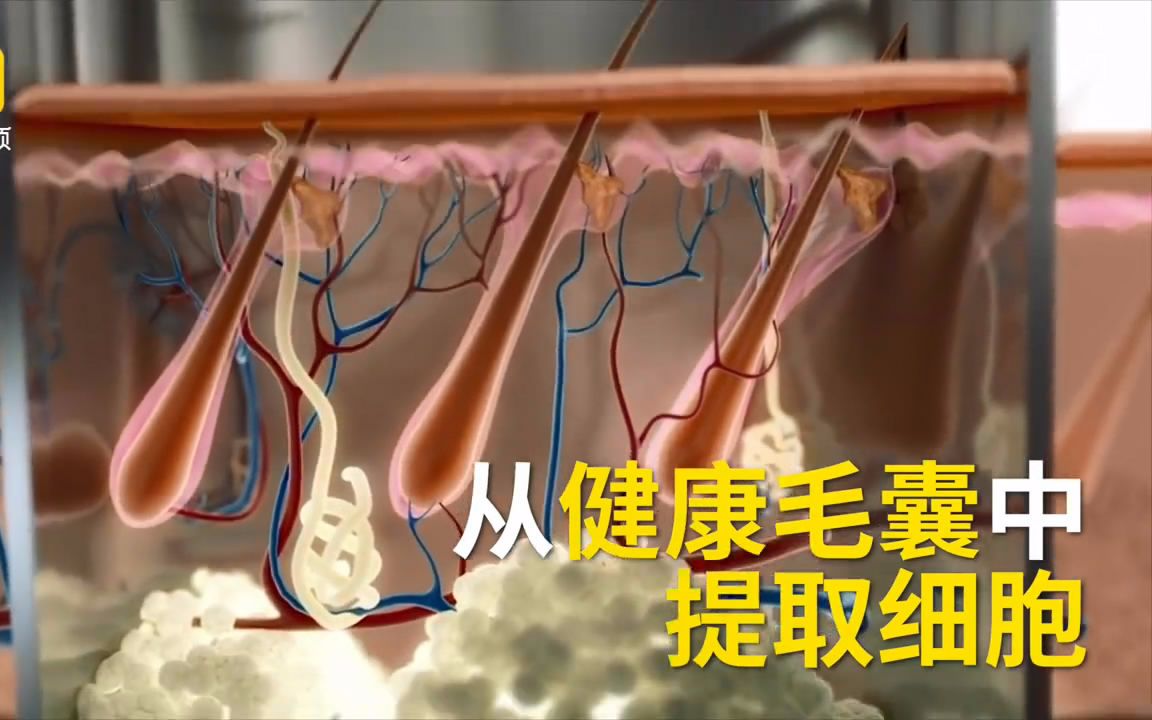 秃顶福音来了:加拿大研发再生技术 @笑笑