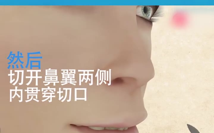 3D动画演绎隆鼻全过程隆鼻手术