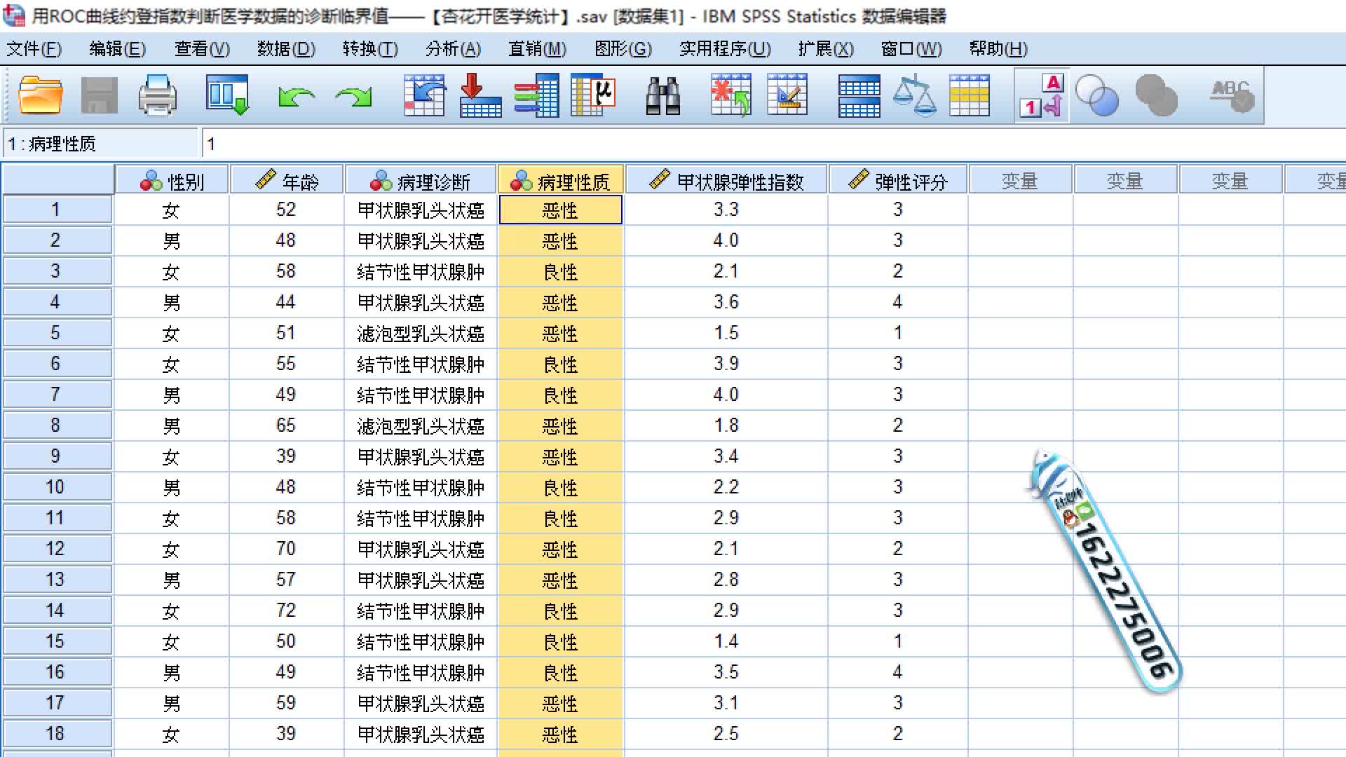 ...中的ROC曲线约登指数判断医学数据的诊断临界值【杏花开医学统计】