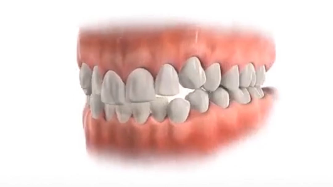 牙齿矫正过程视频演示