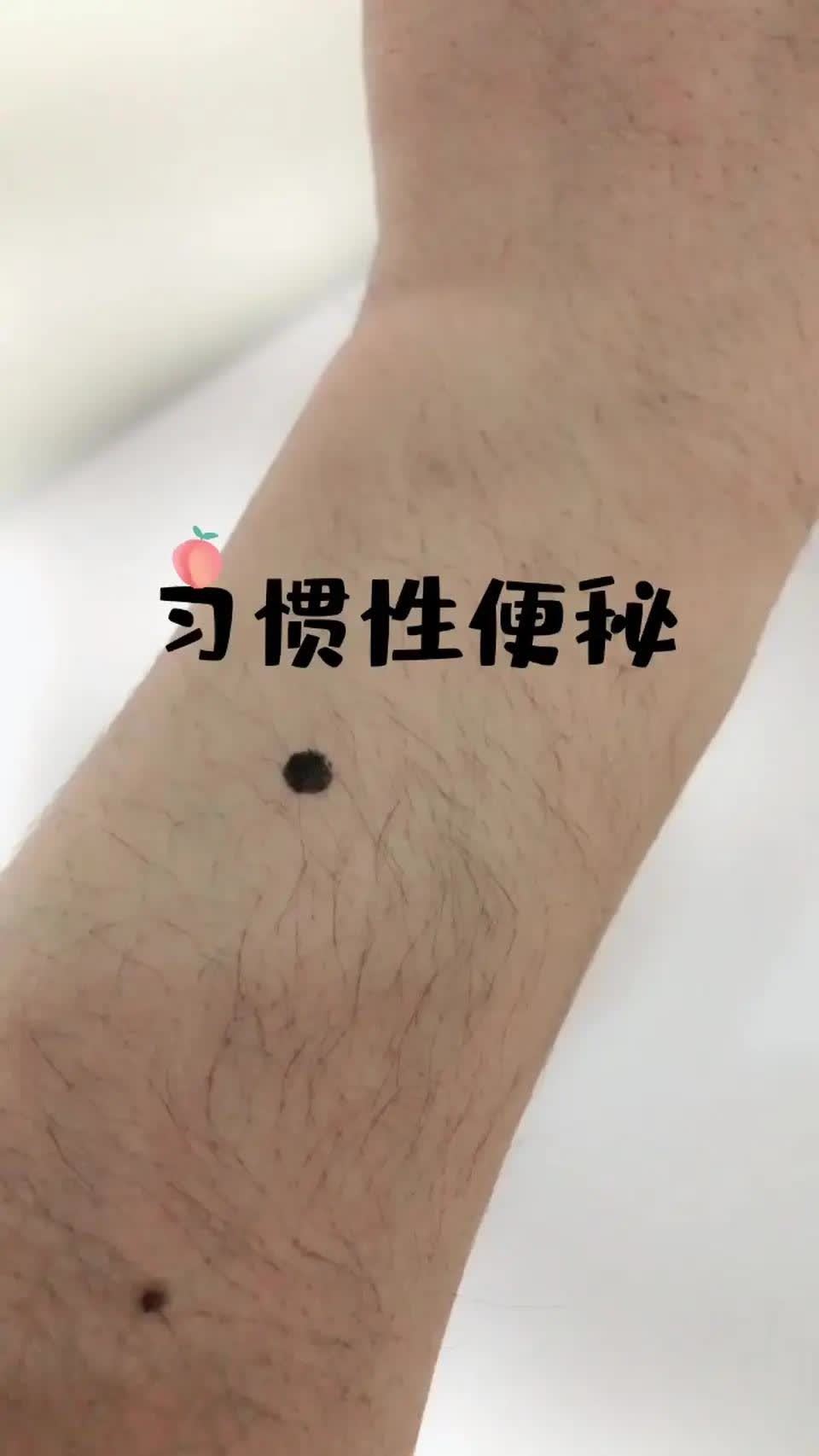 习惯性便秘的同学,请往这里看,支沟穴帮你打通肠道轻松排便!