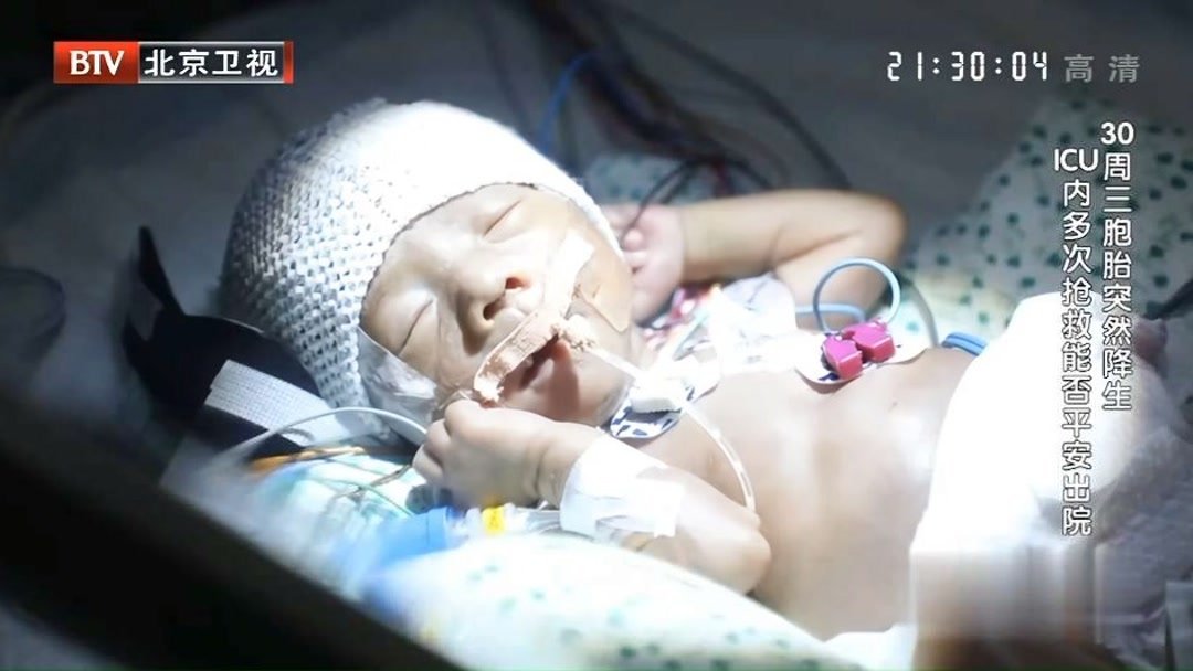 生命缘:三胞胎婴儿一出生就被送去ICU,接连抢救了27天