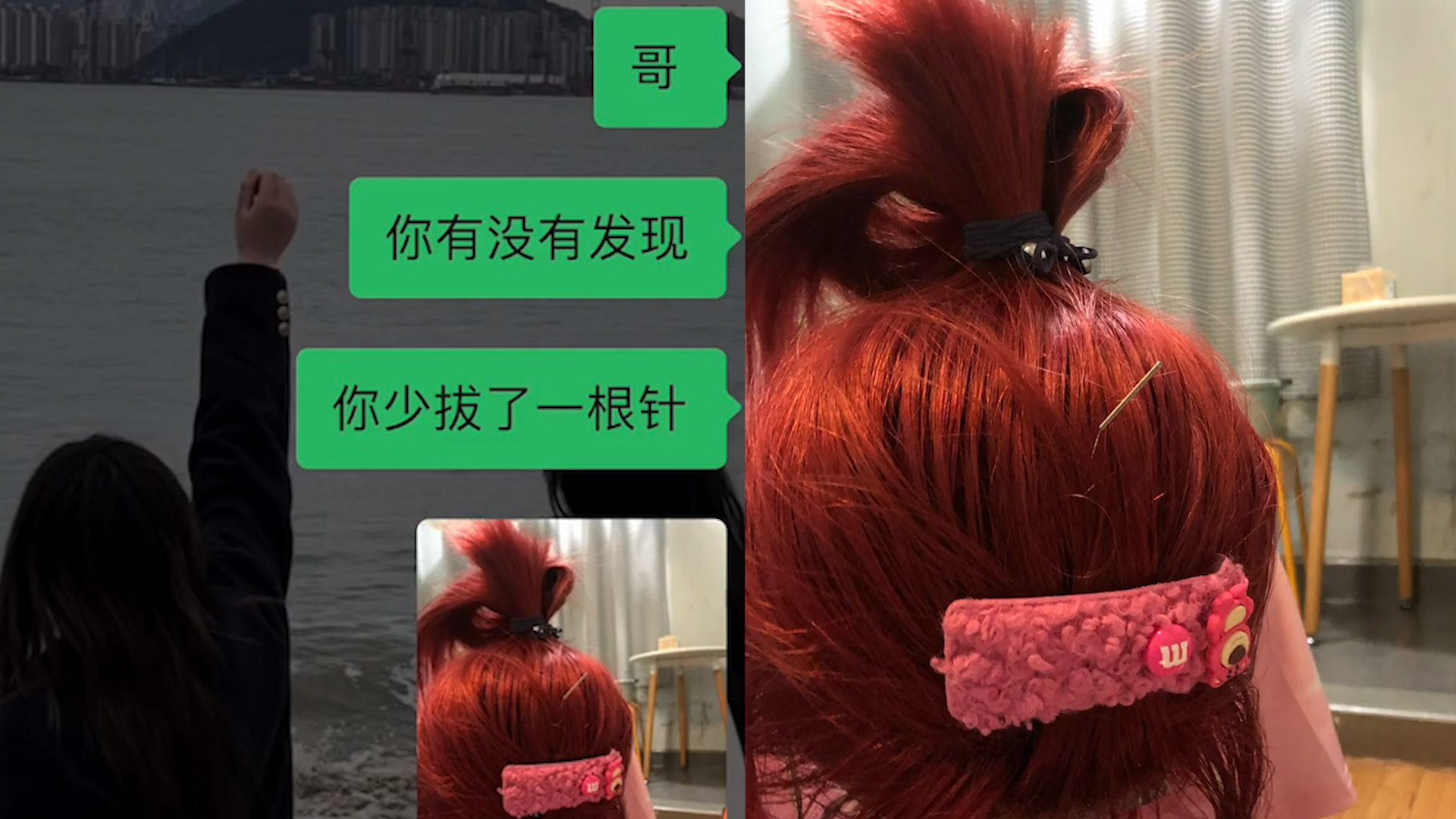 女子针灸头顶一根针5小时忘拔:针都歪了 没觉得害怕很搞笑