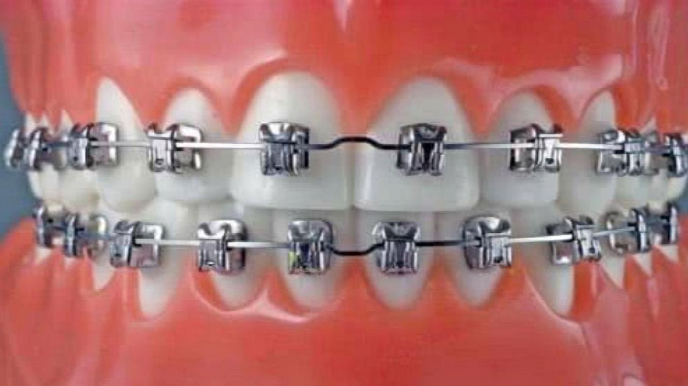 牙套是怎么矫正牙齿的?3D动画演示全过程,看完还敢戴牙套?