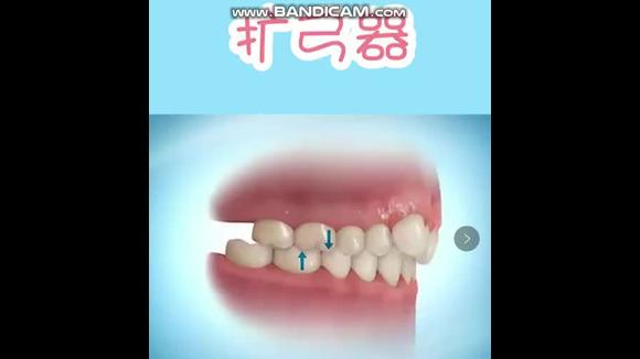 很多人不知道牙齿矫正中的扩弓器是干什么用的,具体看下面视频