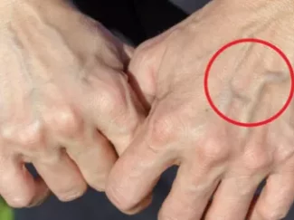 不论男女,若手臂出现这种“怪像”,或许你的血管已堵塞