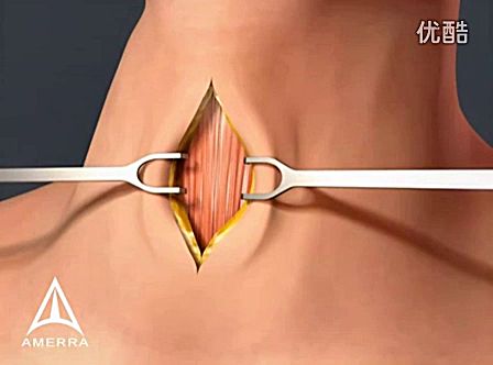 3D医学动画-气管切开术