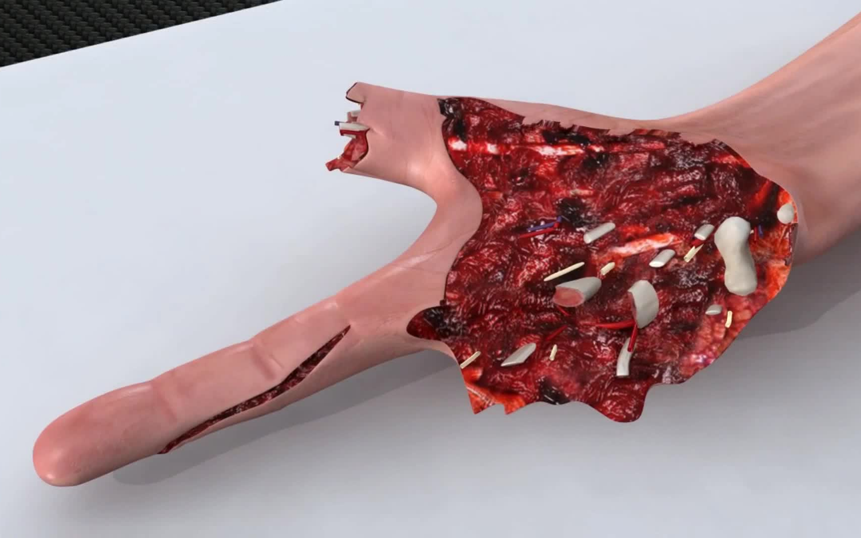 【3D医学动画】胆小禁止入内!只剩一个手指怎么办