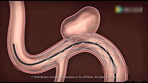 3D动画演示脑动脉瘤栓塞的几种方法