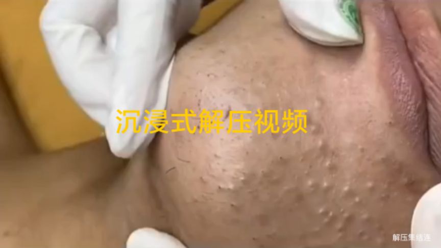 村长的儿子长了满脸青春痘 今天沉浸式带你体验挤痘痘全过程