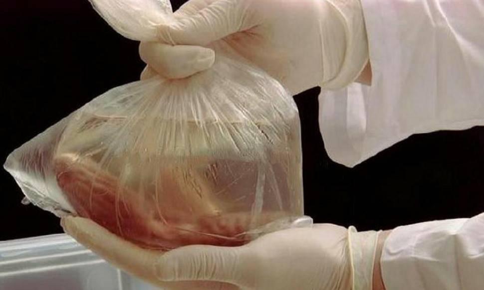 做手术时切下来的器官,都被医生拿来干啥了?镜头拍下全过程