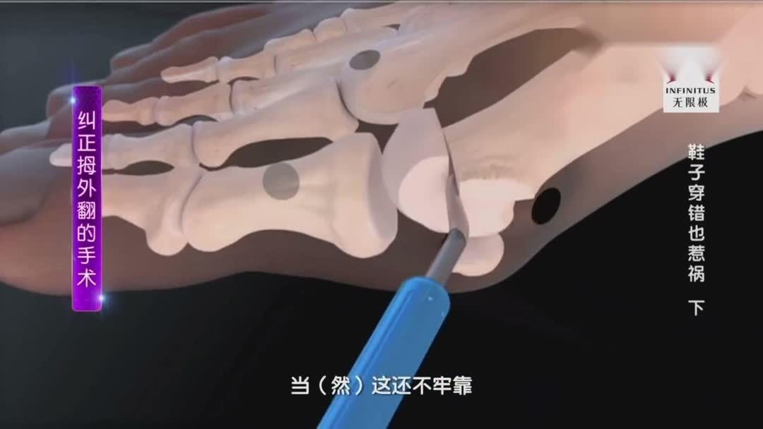 拇外翻矫正手术动画演示,看完你还敢穿高跟鞋吗?