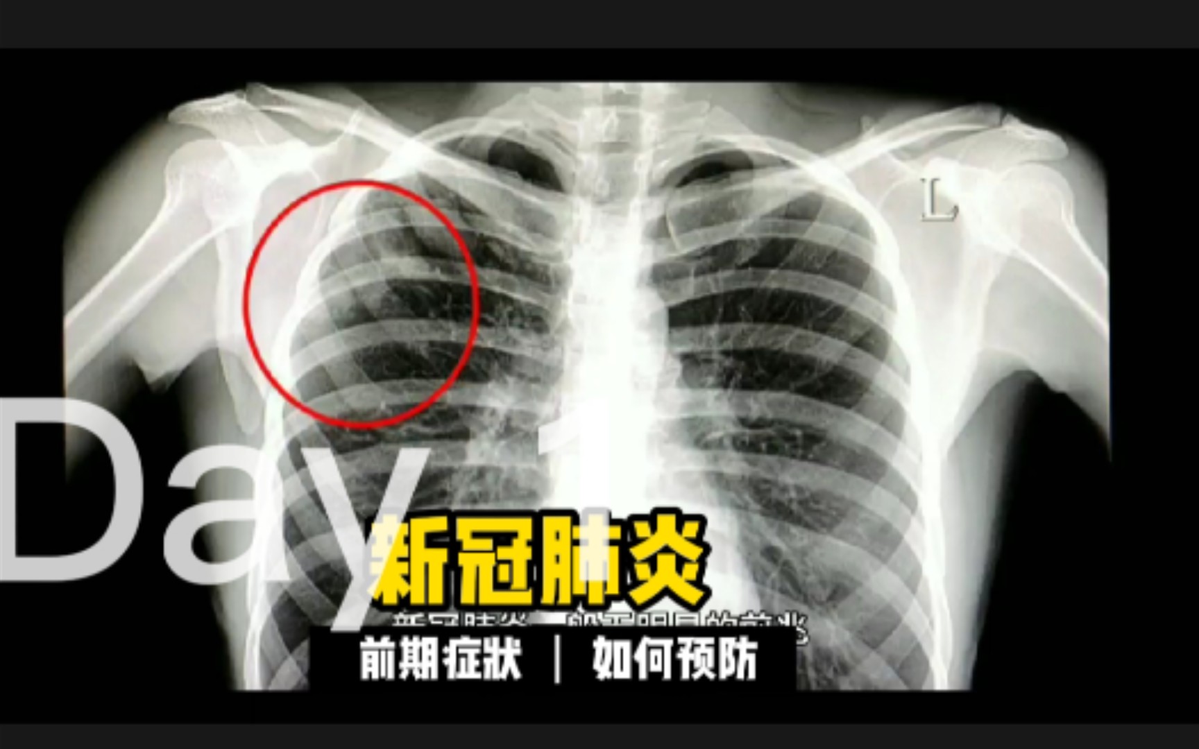 新冠肺炎前期症状,如何预防?