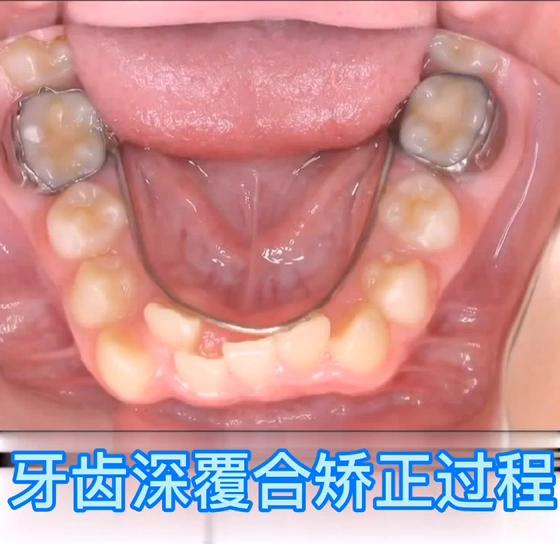 牙齿深覆合矫正过程活动轨迹
