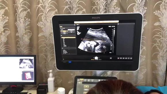 23+2周宝宝做四维彩超,看看小宝宝在肚子里是怎么喝羊水吐泡泡的