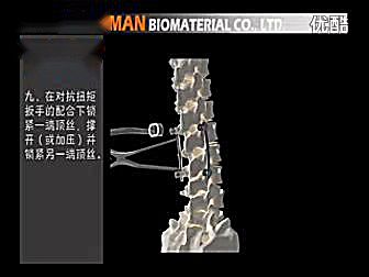 我在脊柱后路钉棒系统(U型)手术操作动画演示截了一段小视频
