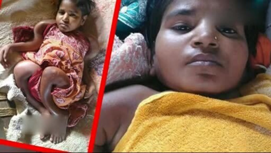 少女染怪病致身体不断萎缩 25岁身高仅60厘米