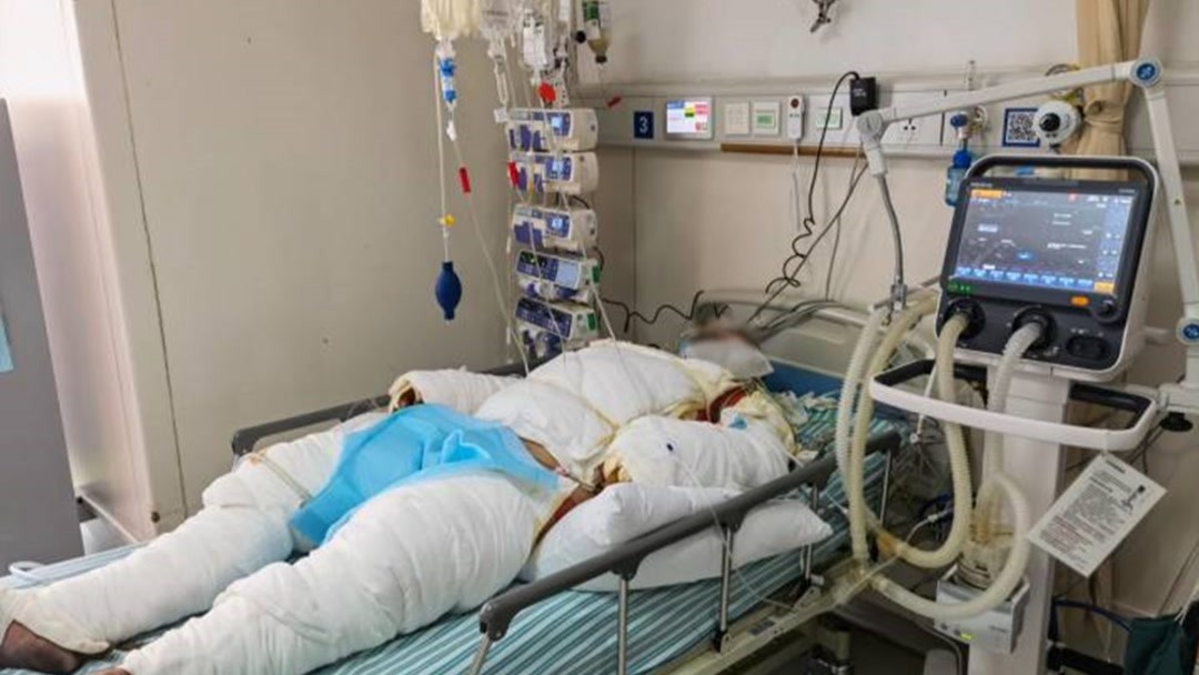 杭州电动车起火爆燃事故父亲烧伤面积超90%,肺部有爆炸伤