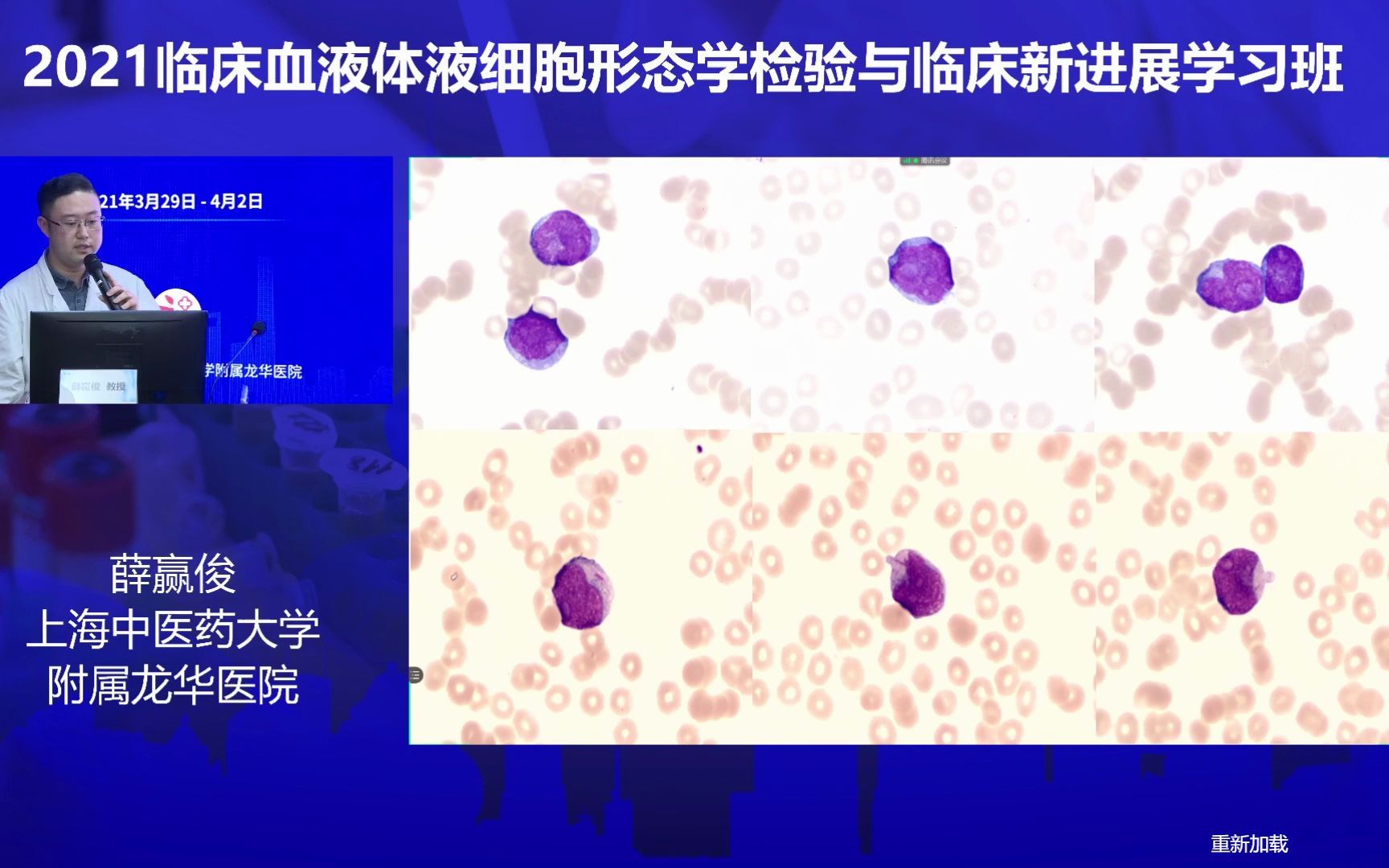 急性髓系白血病骨髓细胞形态学及案例分享