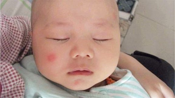 蚊子就爱咬宝宝!夏天来了,教妈妈安全正确驱蚊!