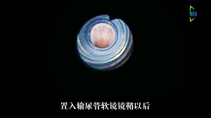 医视屏-置入输尿管软镜