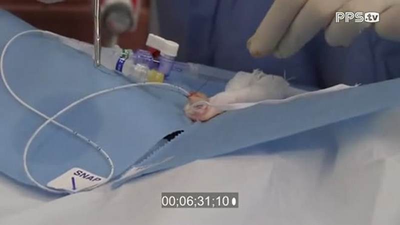 脐静脉和动脉置管演示(国外)