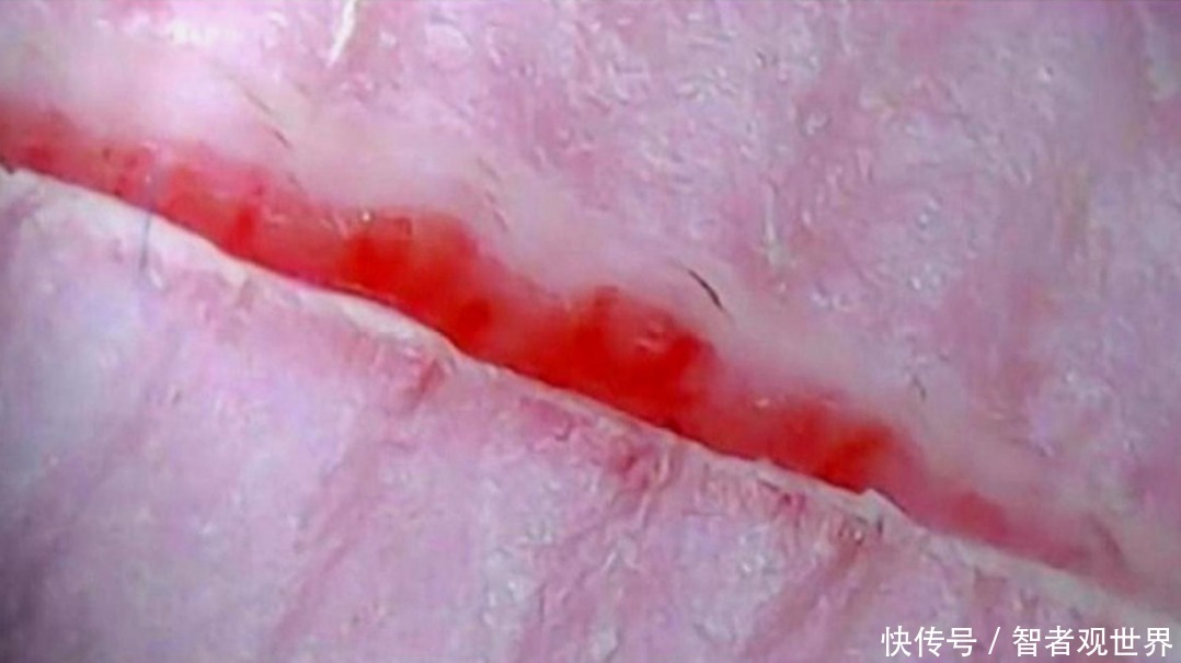 皮肤受伤是怎样愈合的?3D动画还原全过程,看完大开眼界!