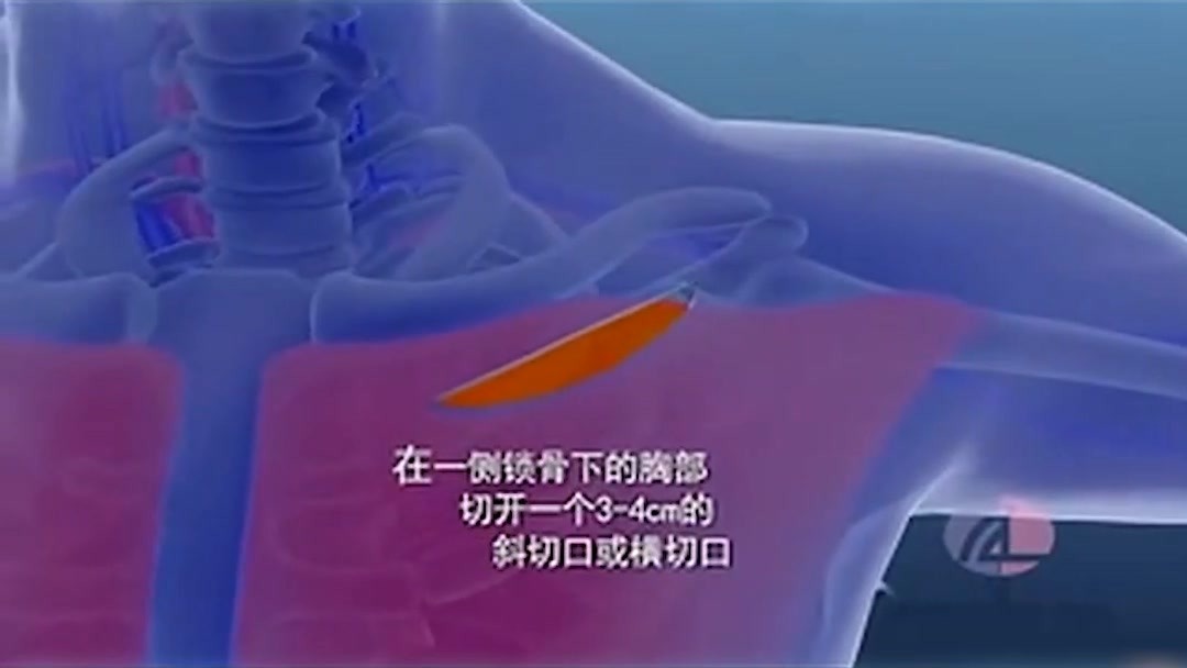 好消息!国产首例临时心脏起搏器获批上市