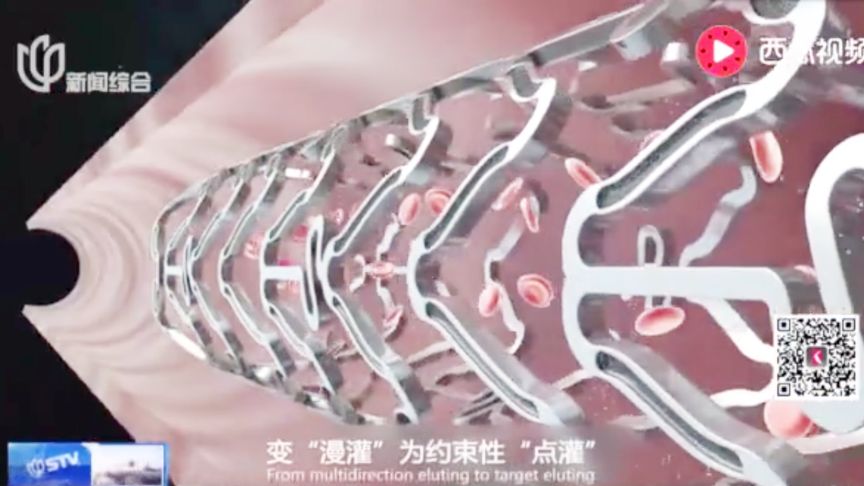 中国医疗器械首登《柳叶刀》“火鹰支架”破解心血管介入难题