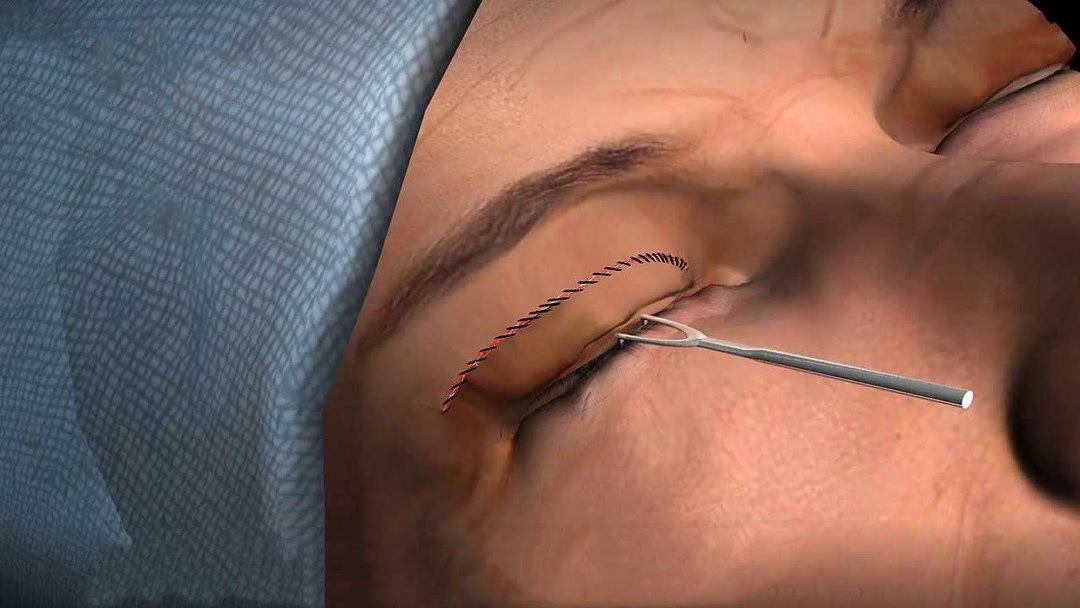 双眼皮手术什么样?动画演示手术过程,这就是一刀的买卖!