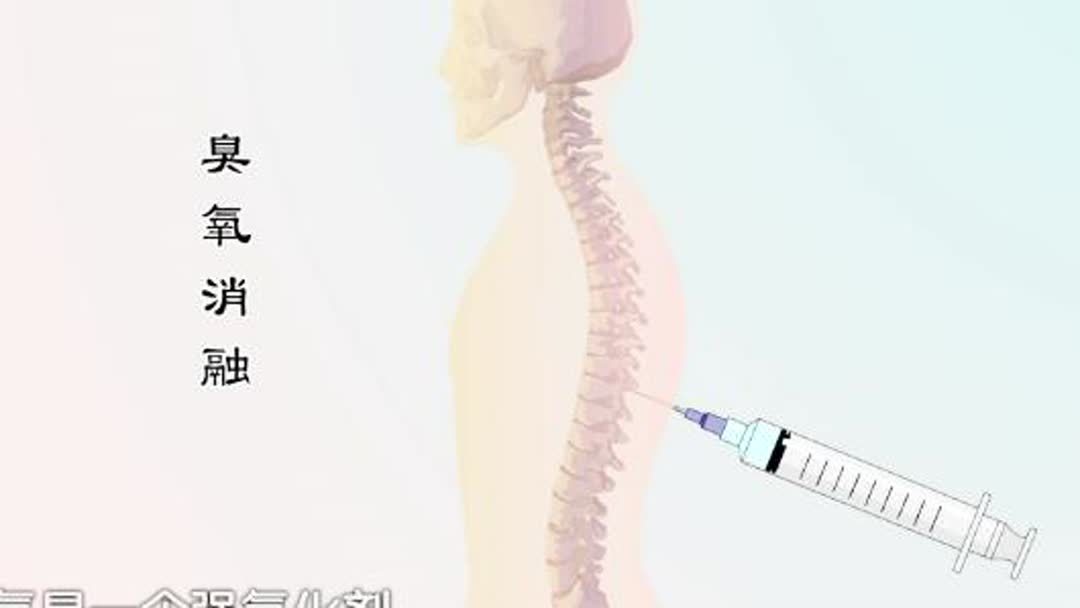 什么是臭氧消融术?臭氧消融术可以治腰椎间盘突出吗?