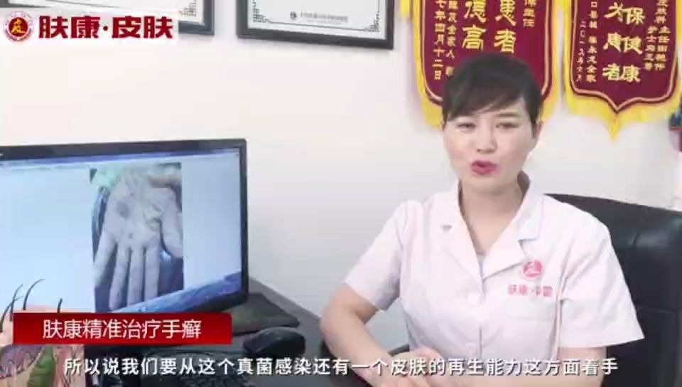 有手癣,小水泡,流脓怎么办?杭州肤康皮肤病医院