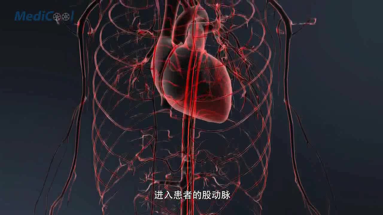 冠状动脉造影心脏支架手术